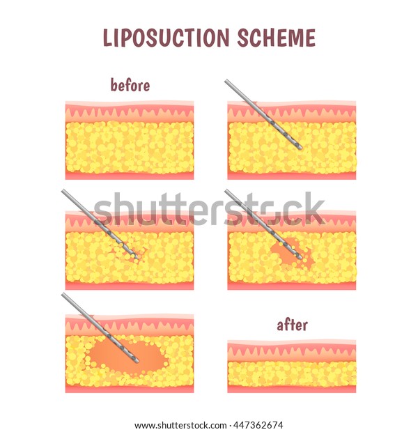 Scheme Cosmetic Surgery Liposuction Illustration Stages Stock Vector ...