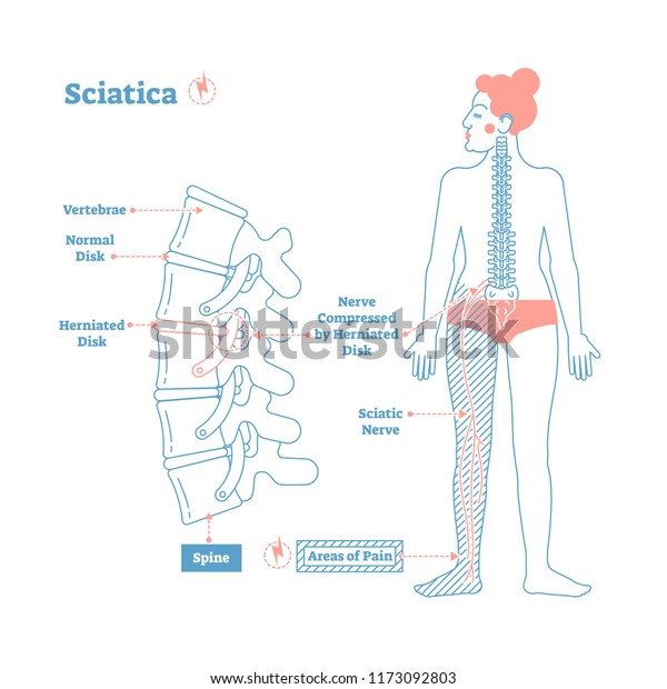 Sciatica Medical Health Care Vector Illustration Stock Vector (Royalty ...