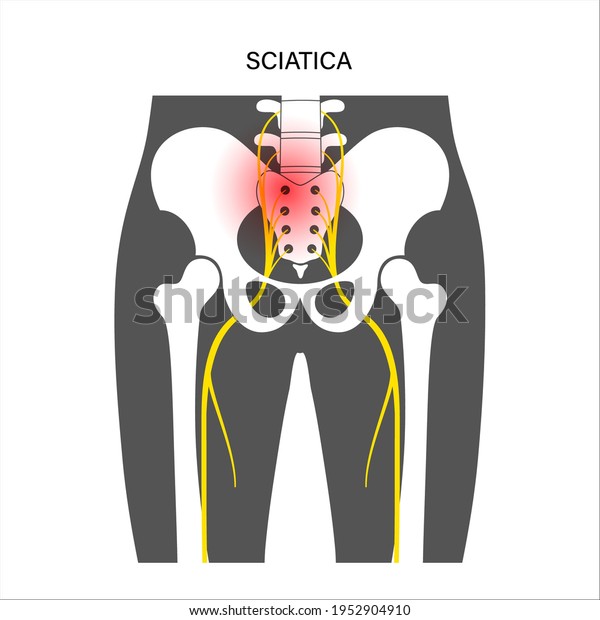 Sciatica Pain Inflammation Pelvis Leg Hip Stock Vector (Royalty Free ...