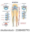 6+ Thousand Sciatica Royalty-Free Images, Stock Photos & Pictures ...