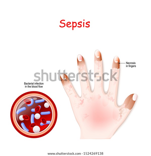 Sepsis Closeup Cross Section Blood Vessel Stock Vector (Royalty Free ...