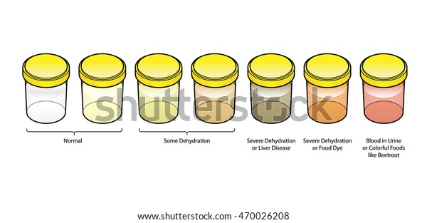 Series Urine Pee Samples Showing Different: เวกเตอร์สต็อก (ปลอดค่า ...