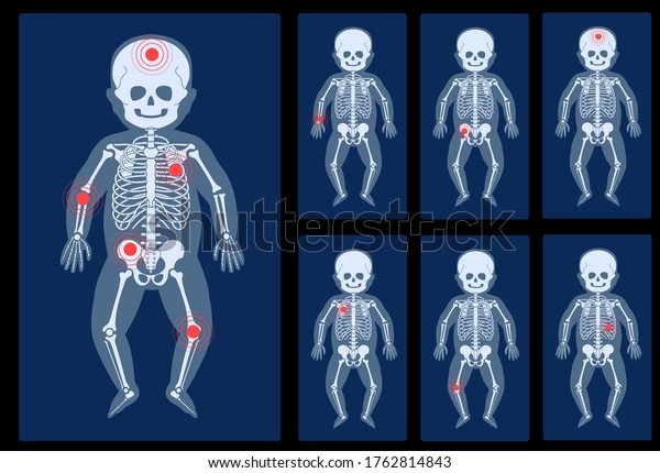 Set Human Child Skeleton Anatomy Front Stock Vector (Royalty Free ...
