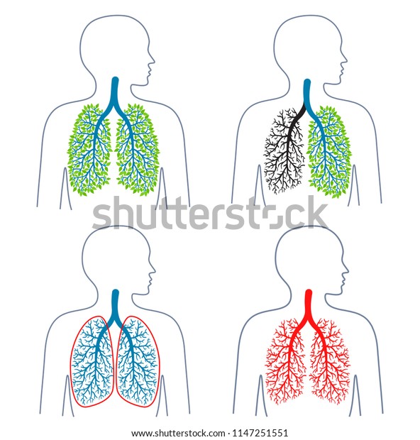 Set Illustrations Respiratory System Themetuberculosis Lung Stock ...