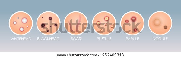 Set Skin Scar Whitehead Pustule Blackhead Stock Vector (Royalty Free ...
