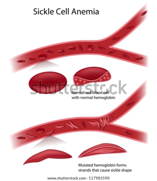 Sickle Cell Disease Stock Vector (Royalty Free) 117983590
