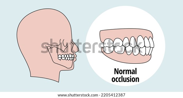 Side View Teeth After Orthodontic Treatment Stock Vector (Royalty Free ...