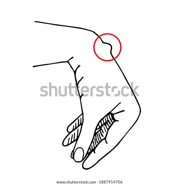 110件の「Finger ganglion cyst」の画像、写真素材、ベクター画像 | Shutterstock