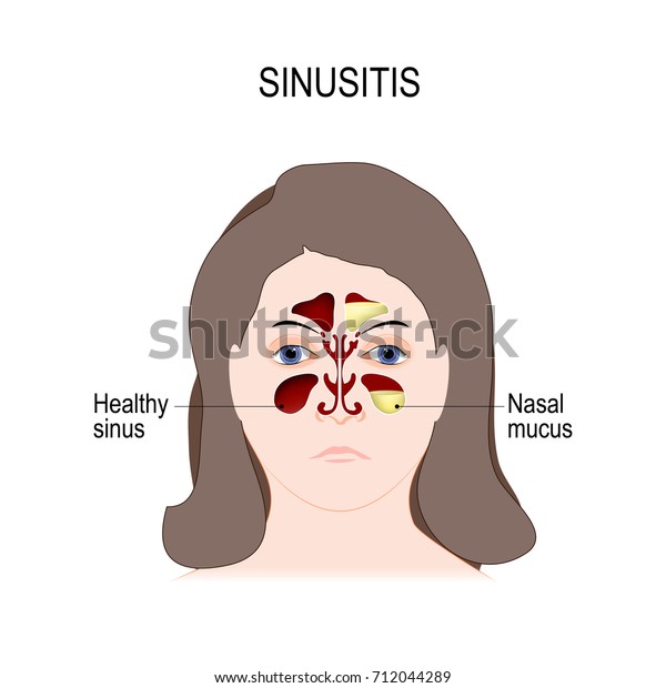Sinusitis Sinus Infection Inflammation Sinuses Rhinosinusitis Stock ...