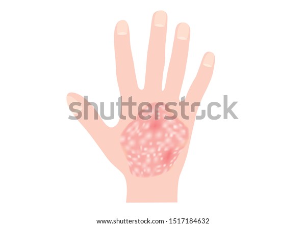 Skin Disease Vector Psoriasis Stock Vector (Royalty Free) 1517184632 ...
