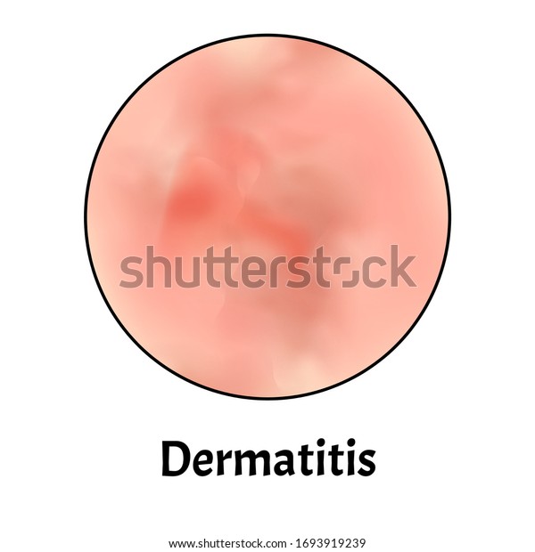 Skin Inflammation Dermatitis Skin Infographics Vector: Vector có sẵn ...