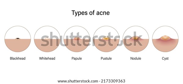 Hautprobleme. Akne-Typen. Köpfe, Whiteheads, Papeln, Pusteln,: Stock ...