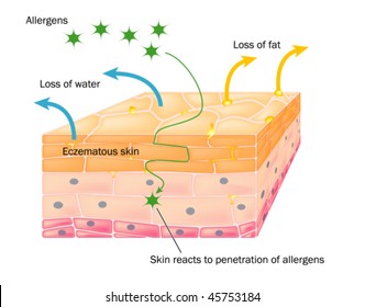 Skin Showing Changes Due Eczema Labeled Stock Vector (Royalty Free ...