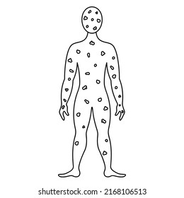 Smallpox On Human Body Sketch Vector Stock Vector (Royalty Free ...
