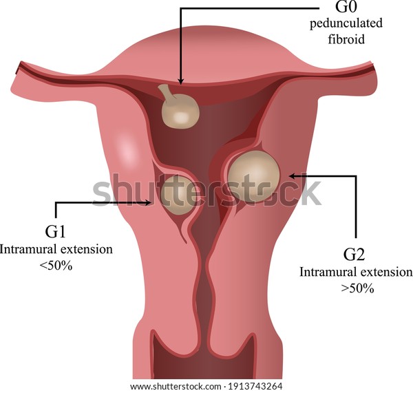 Society Gynaecological Endoscopy Esge Classification Uterine Stock ... Society Gynaecological Endoscopy Esge Classification Uterine Stock ...