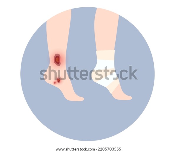 Sore Cut Ulcer On Human Leg Stock Vector (Royalty Free) 2205703555 ...