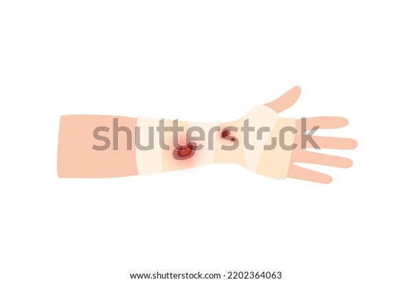 Sore Cut Ulker On Human Arm Stock Vector (Royalty Free) 2202364063 ...