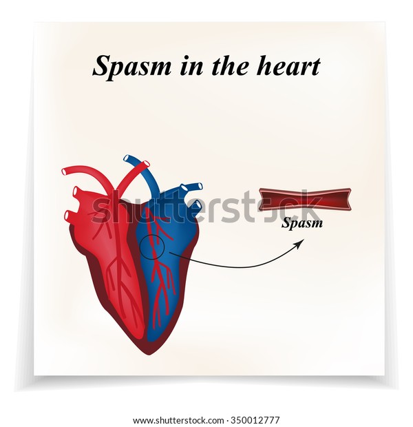 Spasm Arteries Heart Infographics Vector Illustration Stock Vector ...