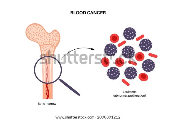 99 Acute Lymphocytic Leukemia Stock Vectors, Images & Vector Art ...