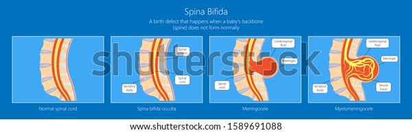 Spina Bifida Birth Defects Infant Disease Stock Vector (Royalty Free ...