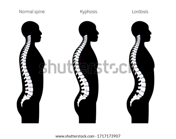 Spinal Deformity Flat Vector Illustration Kyphosis Stock Vector ...