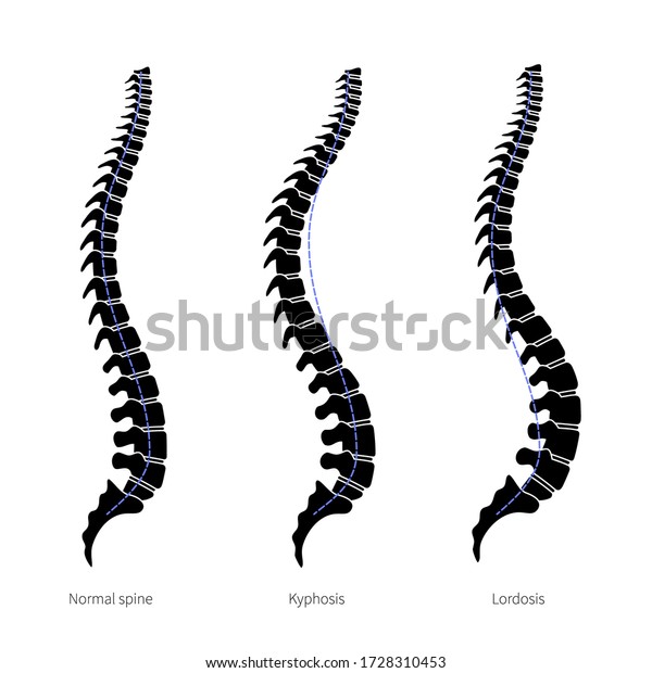 Spinal Deformity Flat Vector Illustration Kyphosis Stock Vector ...