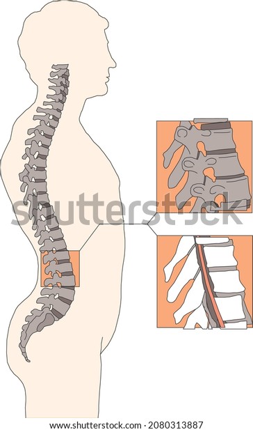 Spinal Deformity Flat Vector Illustration Kyphosis Stock Vector ...