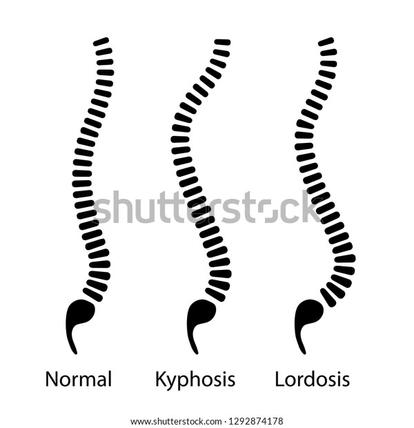 Spinal Deformity Lordosis Kyphosis Black On Stock Vector (Royalty Free ...