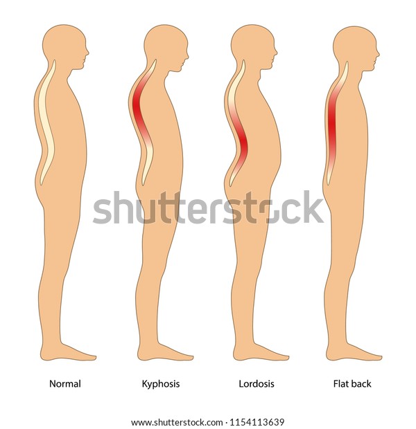 Spinal Deformity Types Lateral View Vector Stock Vector (Royalty Free ...