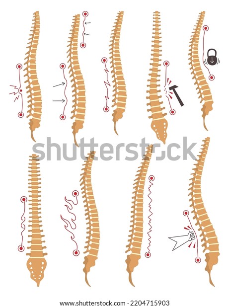 Spinal Deformity Types Symbols Spine Curvatures Stock Vector (Royalty ...