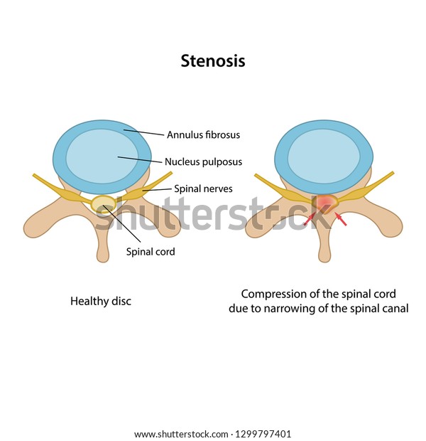 Spinal Stenosis Main Description Healthy Disc Stock Vector Royalty Free 1299797401