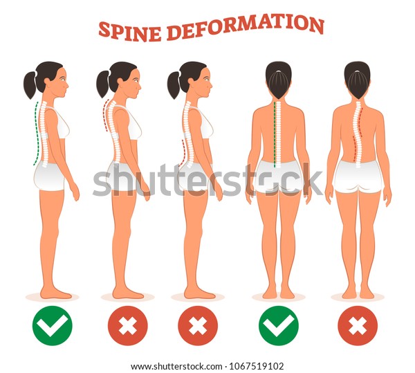 Spine Deformation Types Healthy Spine Comparison Stock Vector (Royalty ...