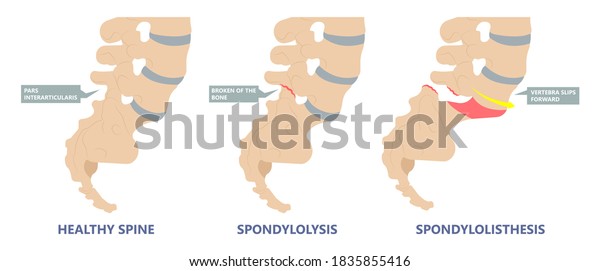 Spondylolisthesis Spinal Disease That Causes One Stock Vector (Royalty ...
