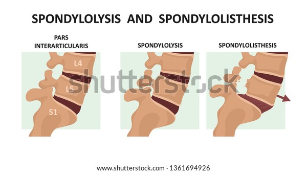 Spondylolysis Spondylolisthesis Stock Vector (Royalty Free) 1361694926