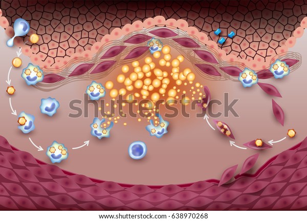 Stable Atherosclerotic Plaque Formation Human Artery Stock Vector ...