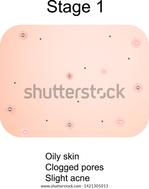 Stage 1 Development Acne Inflamed Skin Stock Vector (Royalty Free ...