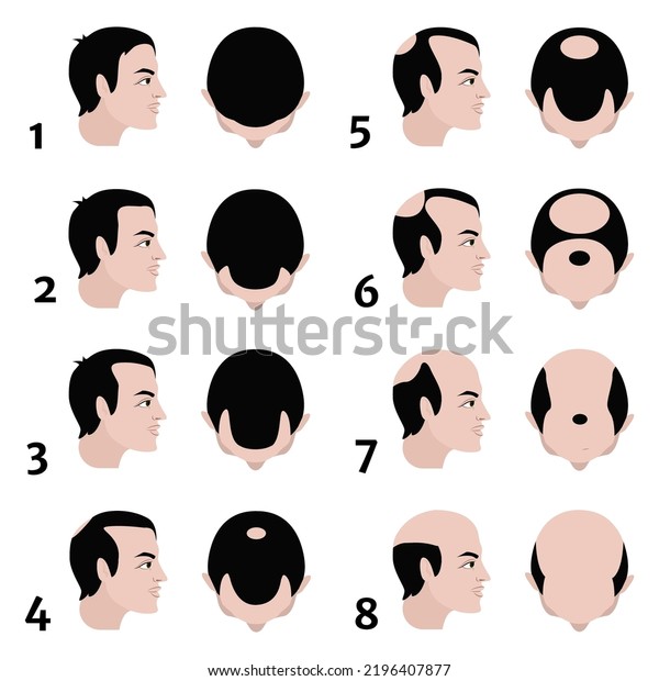 Stages Baldness According Norwood Scale Vector: เวกเตอร์สต็อก (ปลอดค่า ...