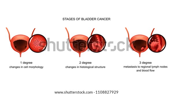 Stages Bladder Cancer Stock Vector (Royalty Free) 1108827929 | Shutterstock