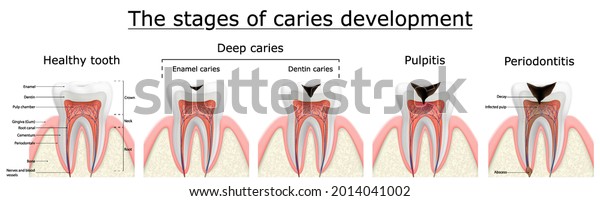Stages Caries Development Dental Disease Caries Stock Vector (Royalty ...