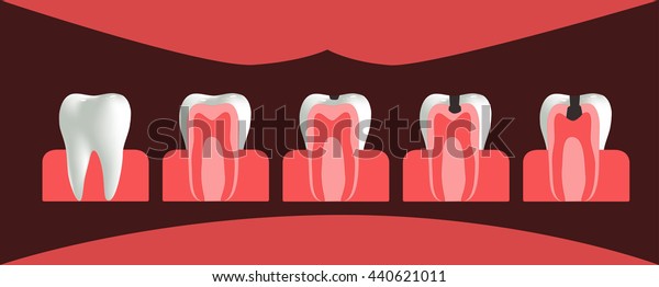 Stages Caries Development Vector Illustration Stock Vector (Royalty ...