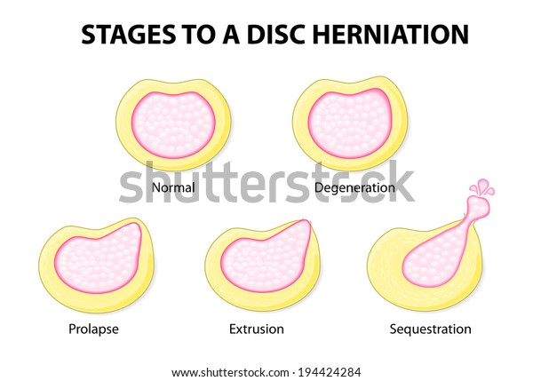 Stages Disc Herniation Normal Degeneration Prolapse Stock Vector ...