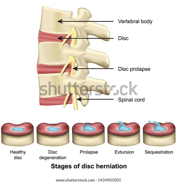 Stages Disc Herniation Spine Disc Anatomy: immagine vettoriale stock ...