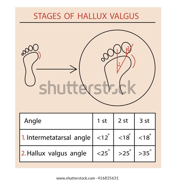 Stages Hallux Valgus Stock Vector (Royalty Free) 416835631 | Shutterstock