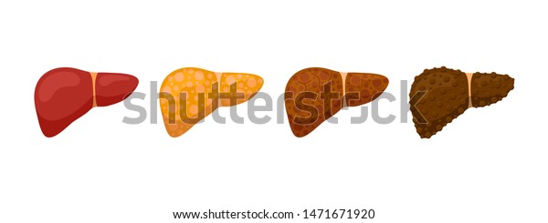 Stages Human Liver Damage Concept Healthy Stock Vector (Royalty Free ...