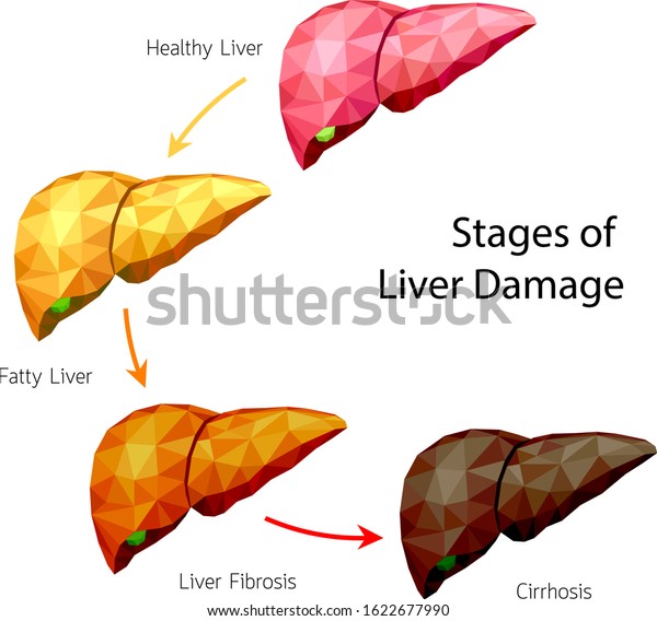 Stages Liver Damage Polygonal Art Style Stock Vector (Royalty Free ...