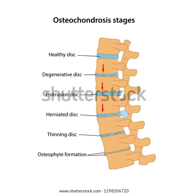 Stages Spinal Osteochondrosis Main Description Healthy 스톡 벡터(로열티 프리 ...