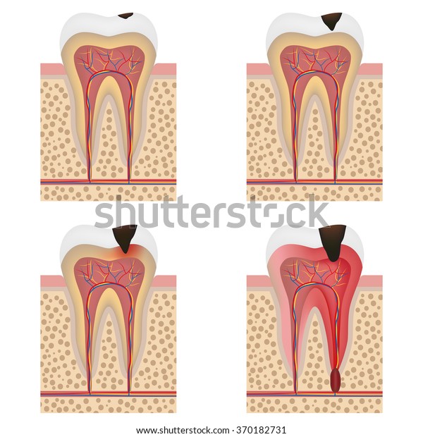 Stages Tooth Decay Illustration Development Dental Stock Vector ...