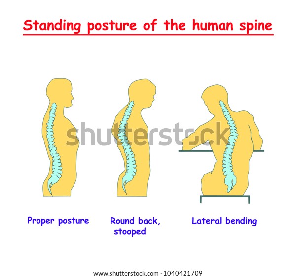 Standing Posture Human Spine Defects Human: เวกเตอร์สต็อก (ปลอดค่า ...