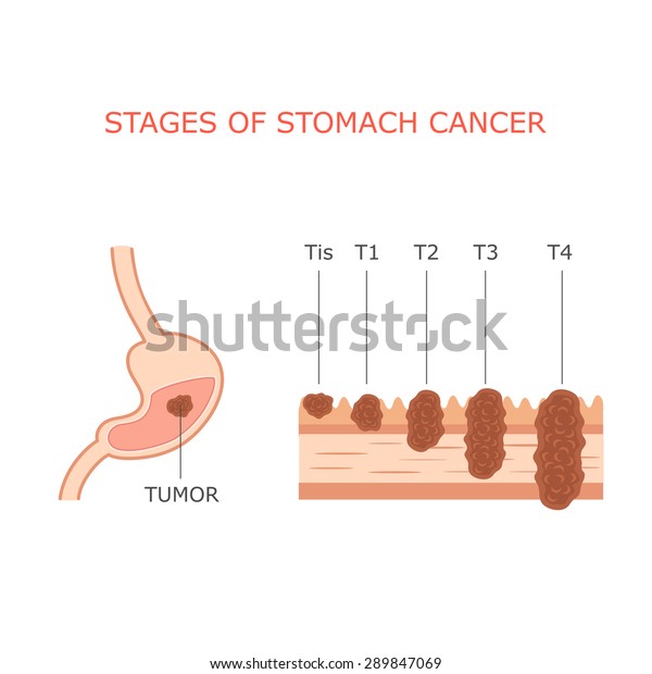 Stomach Cancer Stages Human Gastric Tumor 스톡 벡터(로열티 프리) 289847069 Stomach Cancer Stages Human Gastric Tumor 스톡 벡터(로열티 프리) 289847069