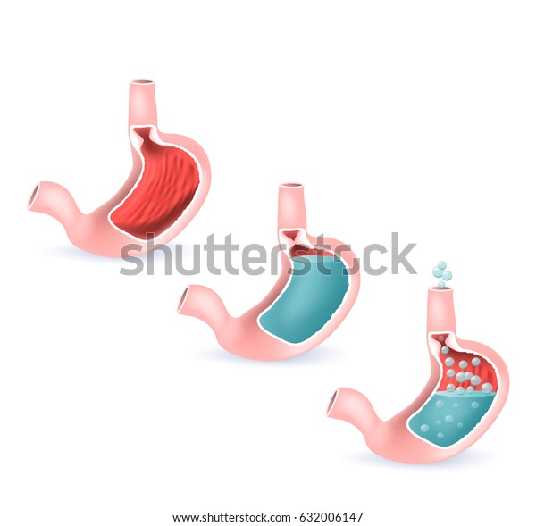 Stomach and digestive. Full and empty stomach, and gastroesophageal ...